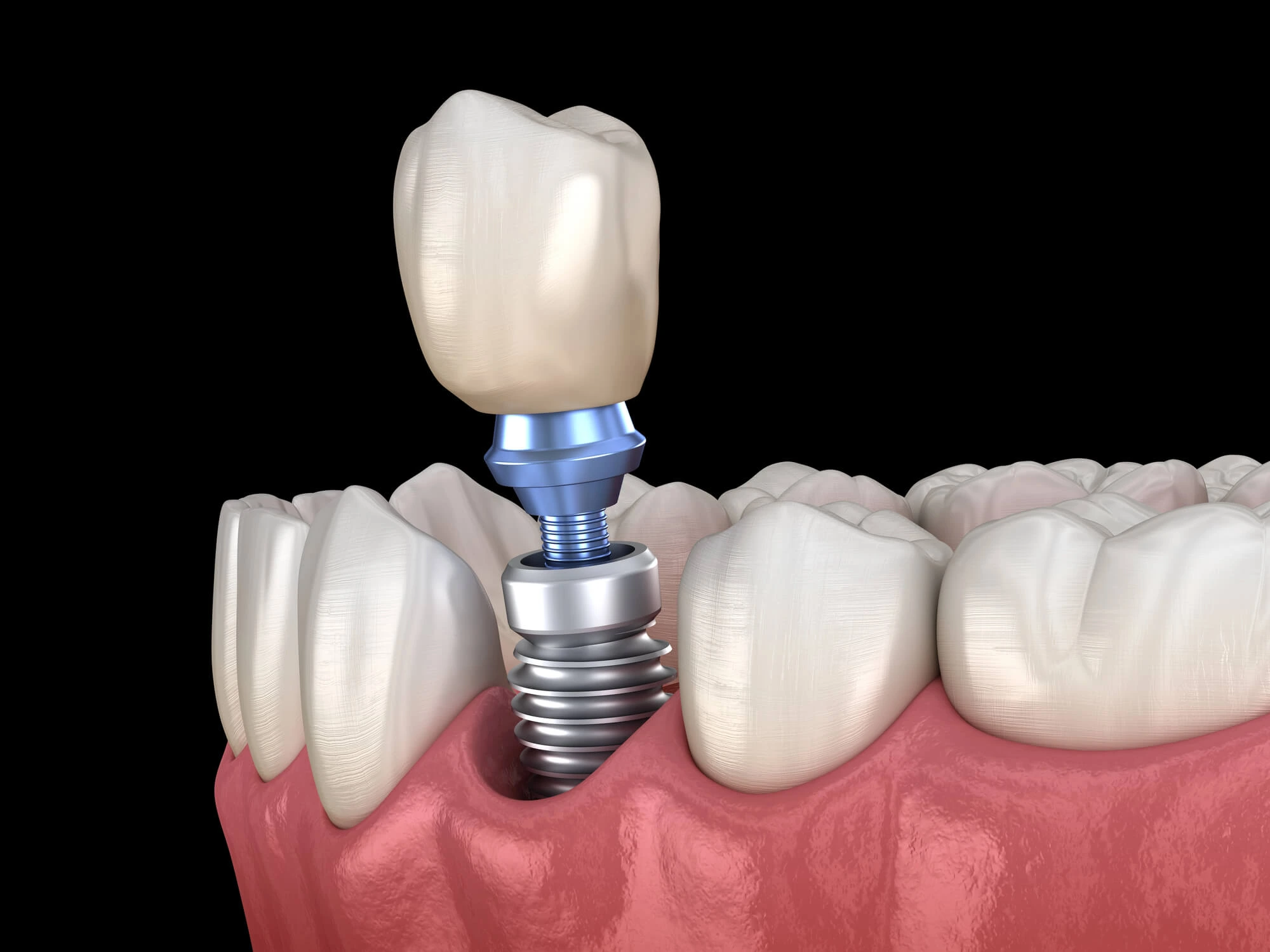 How Often Do I Need Dental Cleanings with Implants? - MIGUEL FERRER, DDS